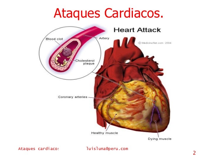 Ataque Cardiaco