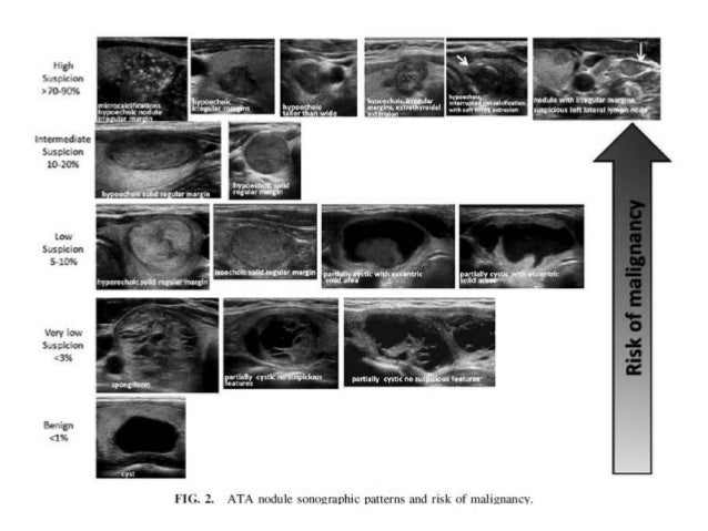 ATA thyroid 2015