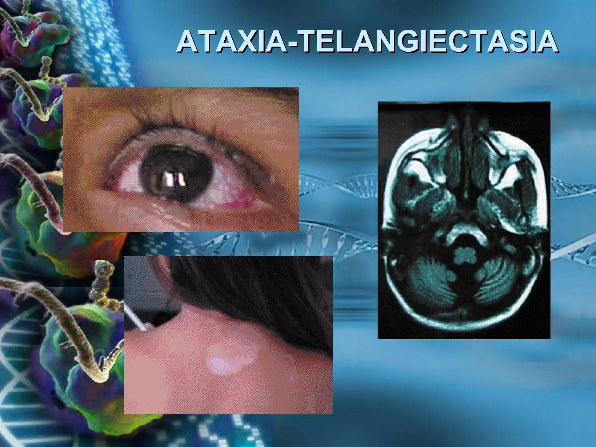 Ataxia telangiectasia | PPT