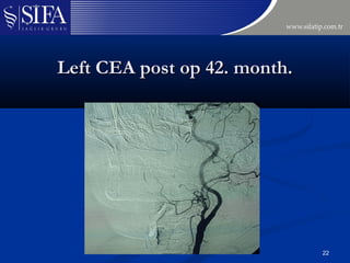 A technical modification of carotid endarterectomy experience with 400 ...