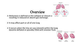 ATELACTASIS.pptx | Lung and Respiratory Health | Diseases and Conditions