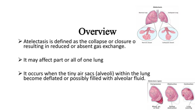 ATELACTASIS.pptx | Lung and Respiratory Health | Diseases and Conditions