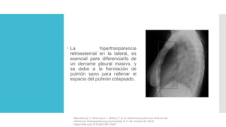 Atelectasia Lobar y Segmentaria......... | PPTX