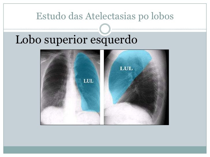 Atelectasias e pneumotrax