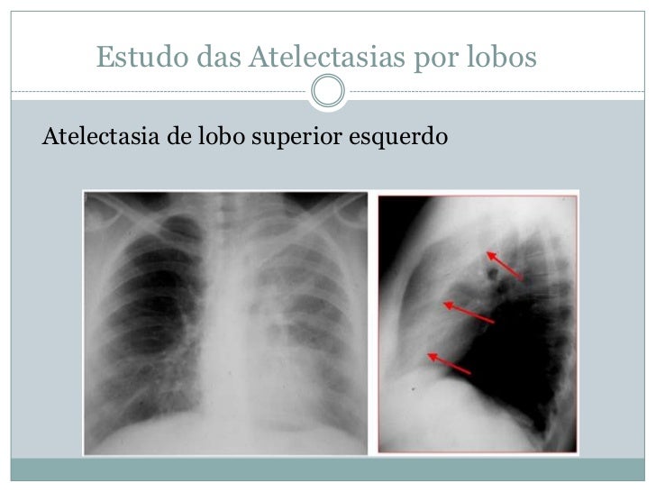 Atelectasias e pneumotrax