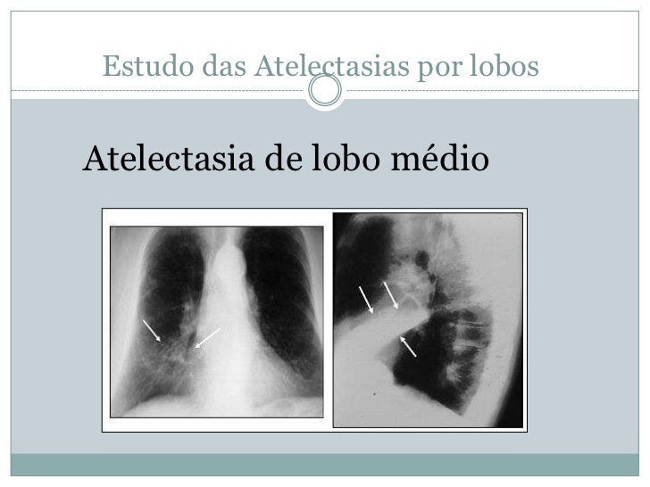 Atelectasias e pneumotrax