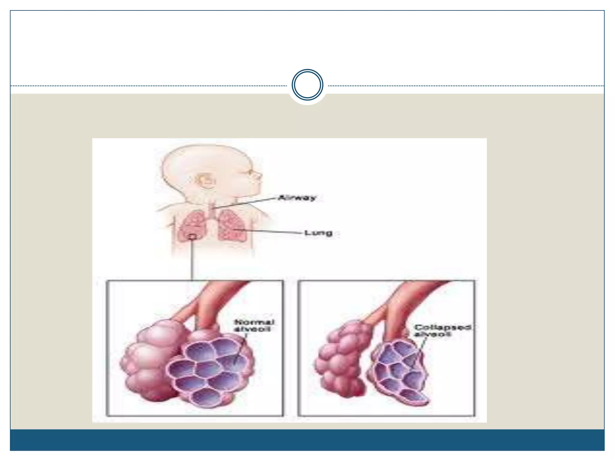 Atelectasis | PPTX