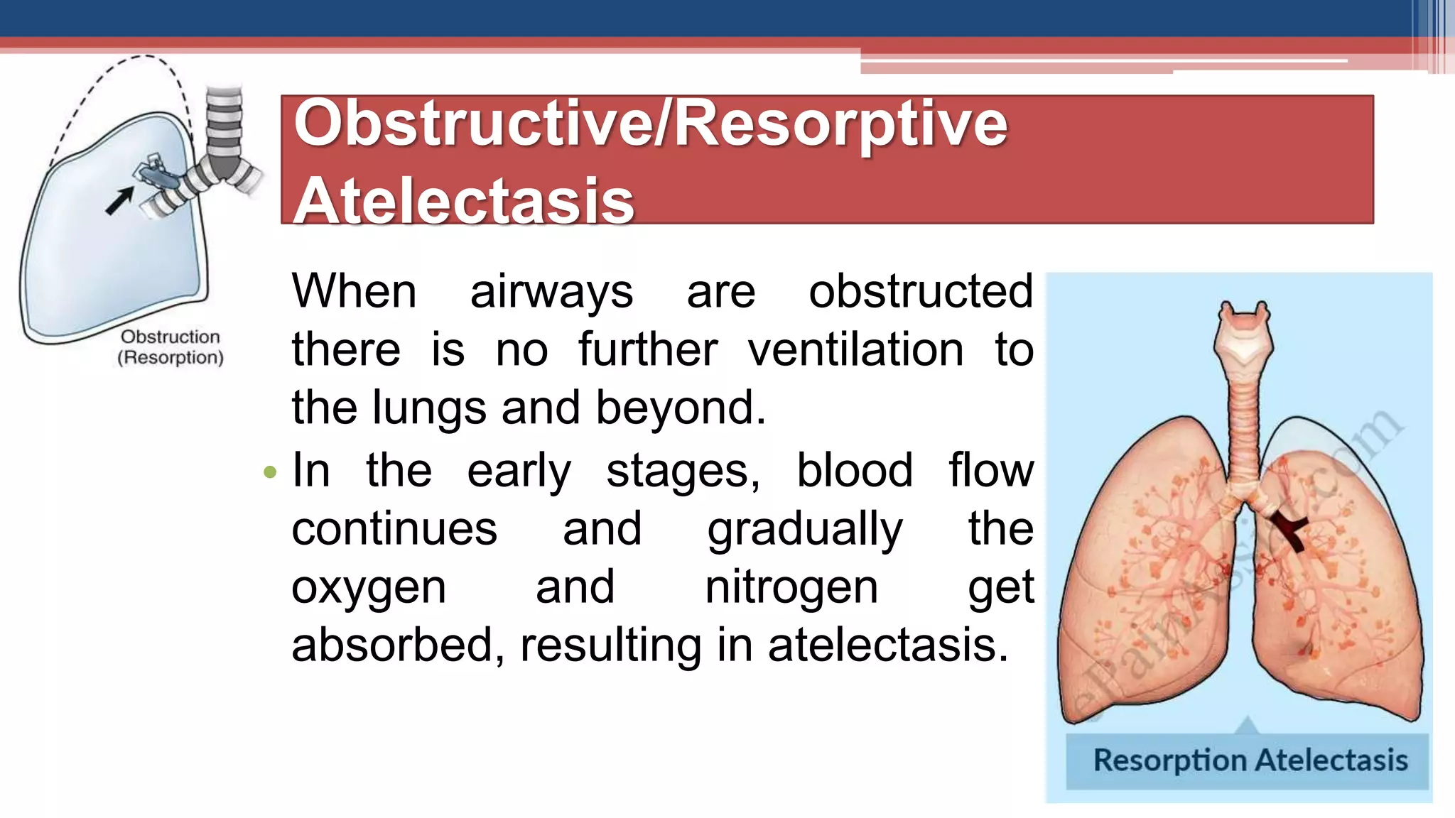Atelectasis | PPTX