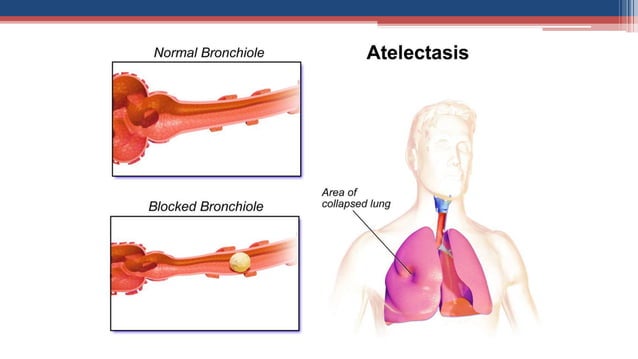 Atelectasis | PPTX | Lung and Respiratory Health | Diseases and Conditions