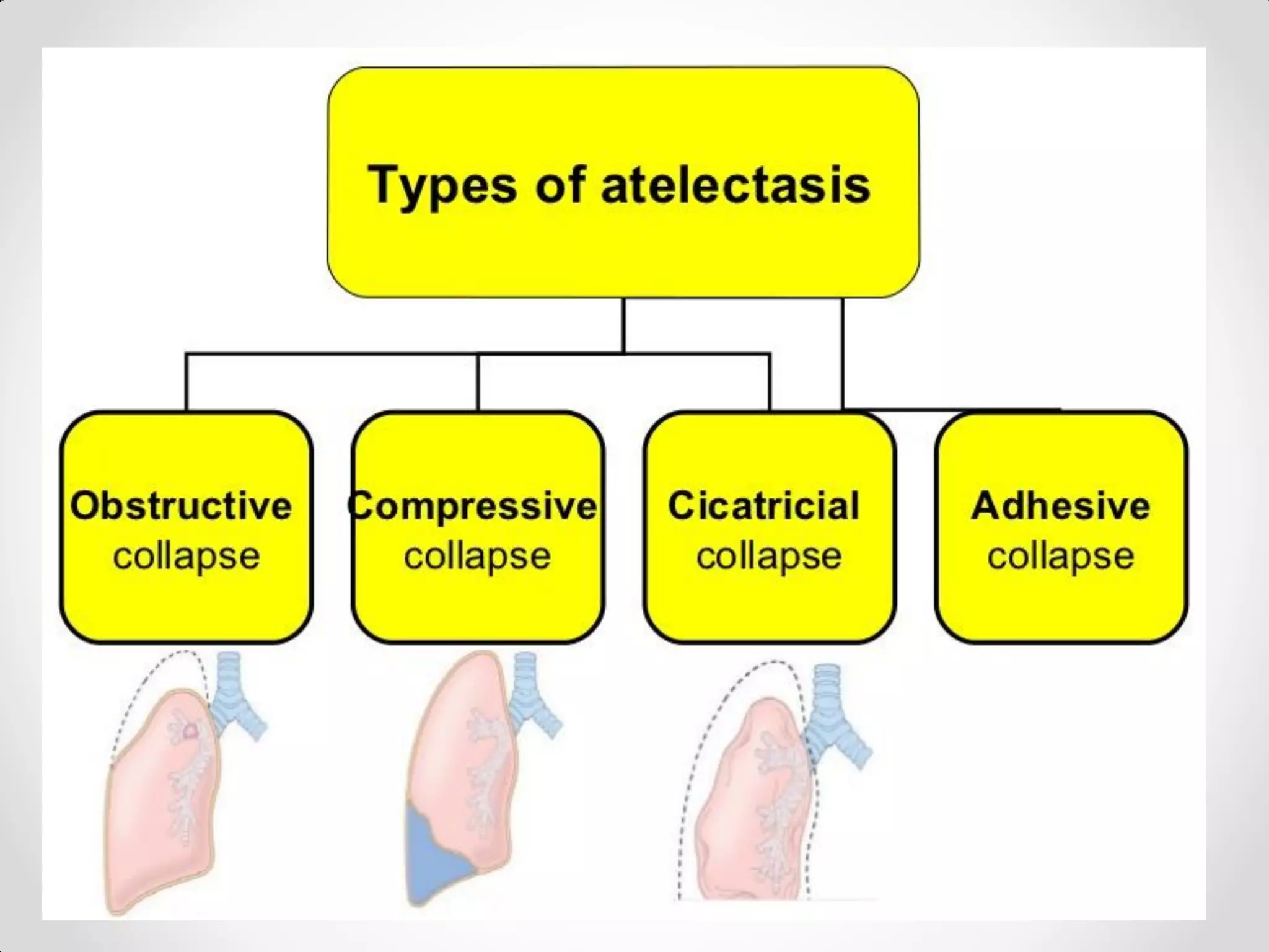 Atelectasis- Easy explanation | PDF