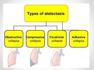 Atelectasis Diagram