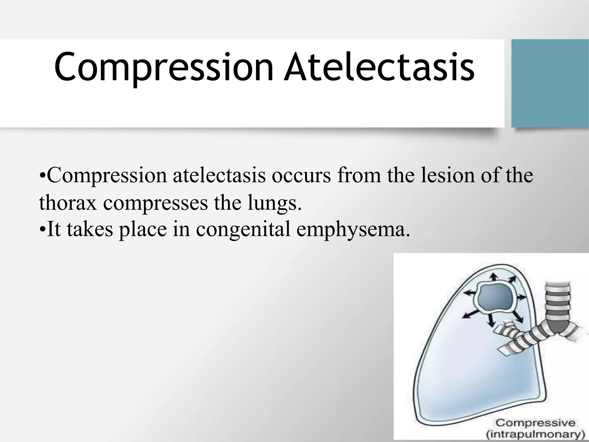 Atelectasis | PPTX