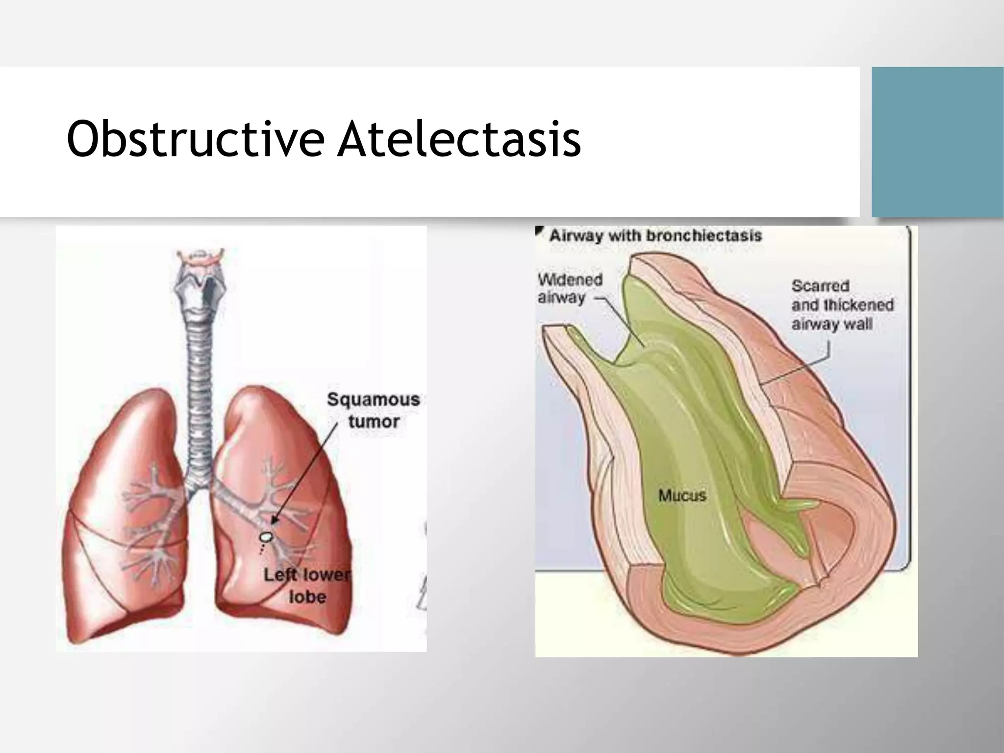 Atelectasis | PPTX