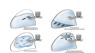 Atelectasis.pdf | PPT