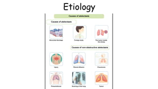 Atelectasis.pdf | PPT