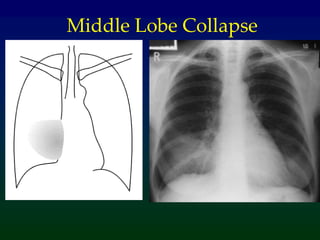 atelectasis The Lung Condition and Management | PPT | Lung and ...