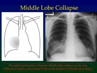 atelectasis The Lung Condition and Management | PPT | Lung and ...