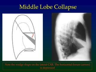atelectasis The Lung Condition and Management | PPT | Lung and ...