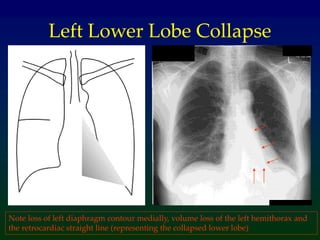 atelectasis The Lung Condition and Management | PPT | Lung and ...