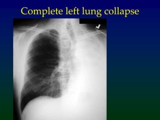 atelectasis The Lung Condition and Management | PPT | Lung and ...