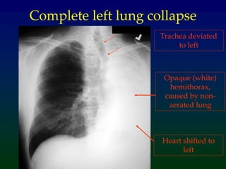 atelectasis The Lung Condition and Management | PPT | Lung and ...