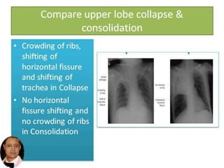 ATELECTASIS LUNG COLLAPSE PART-2 BY DR BASHIR ASSOCIATE PROFESSOR ...