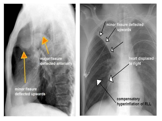 ATELECTASIS LUNG COLLAPSE PART-2 BY DR BASHIR ASSOCIATE PROFESSOR ...