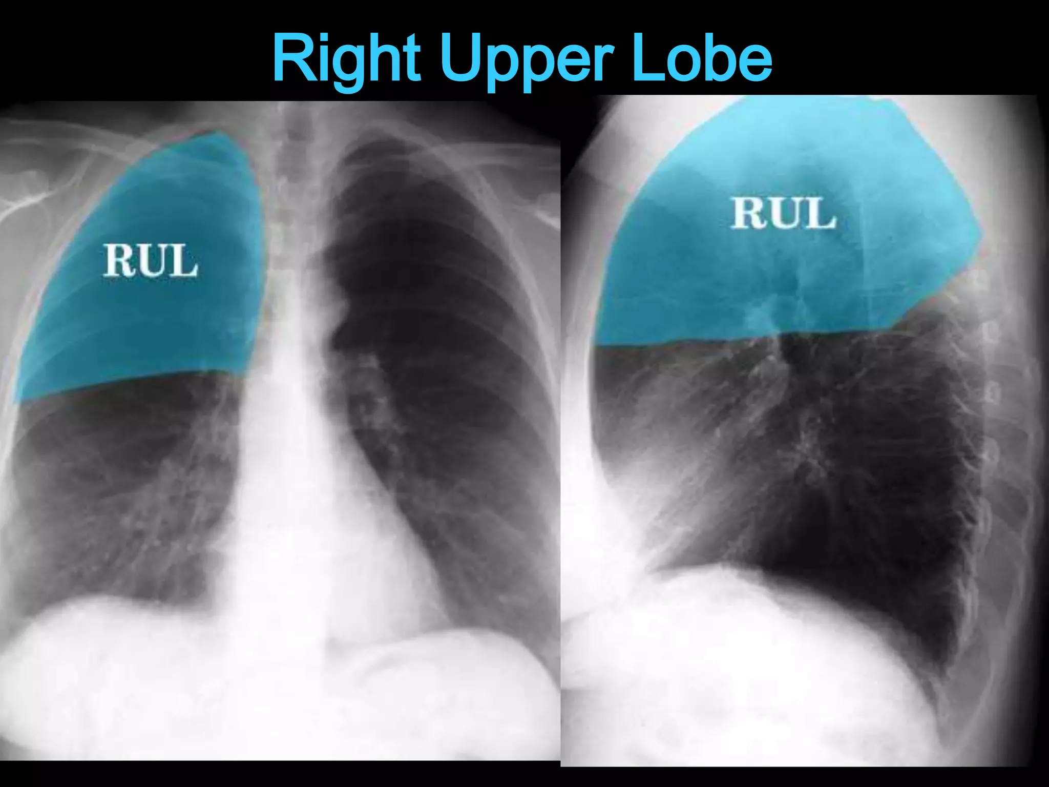 Atelectasis and collapse in CXR | PPTX