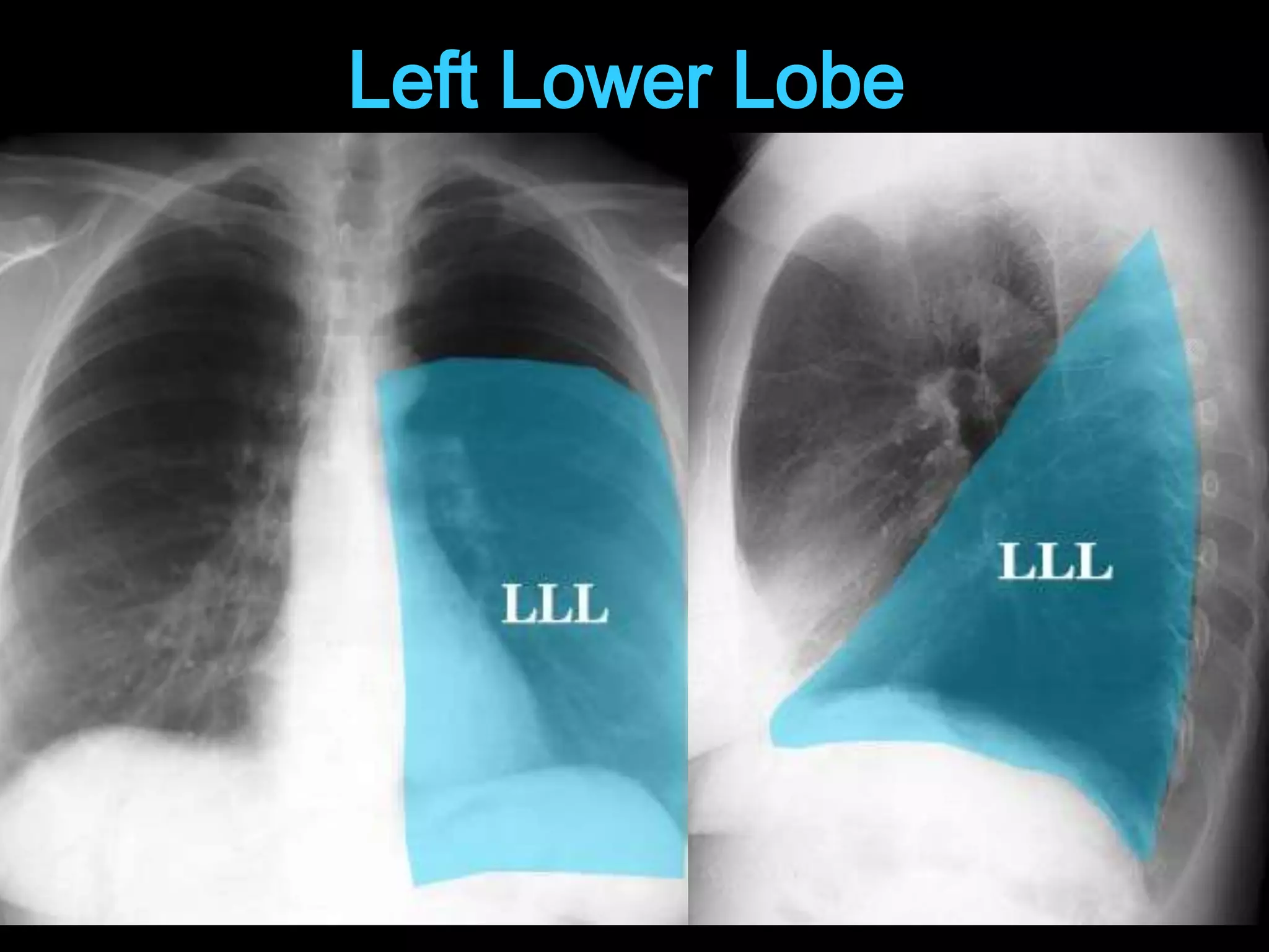 Atelectasis and collapse in CXR | PPTX