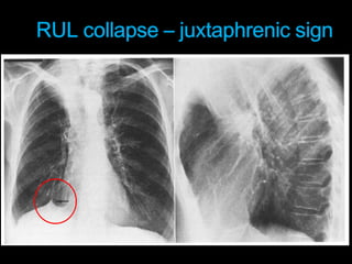 Atelectasis and collapse in CXR | PPTX
