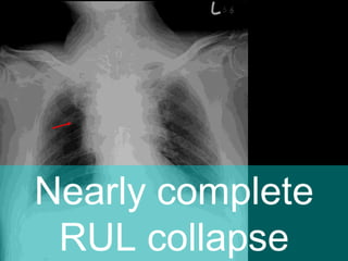 Atelectasis and collapse in CXR | PPTX