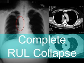 Atelectasis and collapse in CXR | PPTX