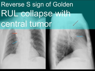 Atelectasis and collapse in CXR | PPTX