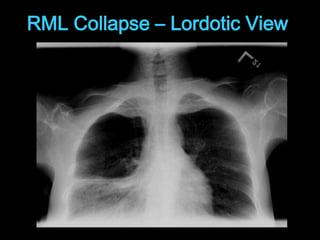 Atelectasis and collapse in CXR | PPTX