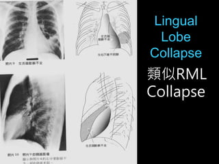 Atelectasis and collapse in CXR | PPTX