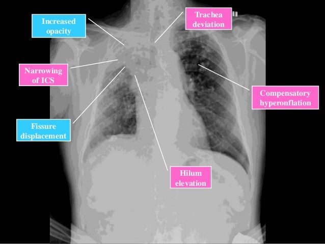 Atelectasis and collapse in CXR