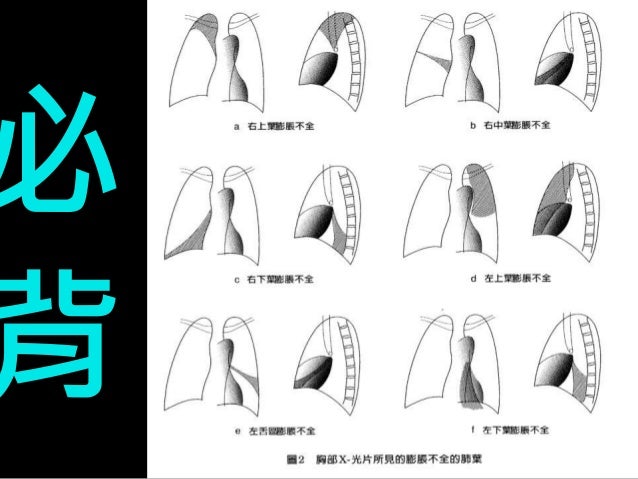 Atelectasis and collapse in CXR