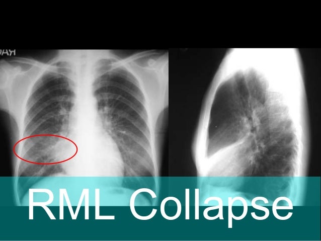 Atelectasis and collapse in CXR