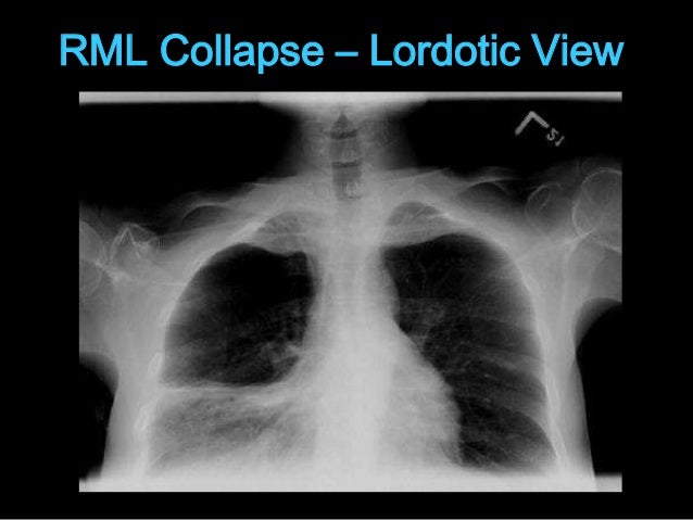 Atelectasis and collapse in CXR