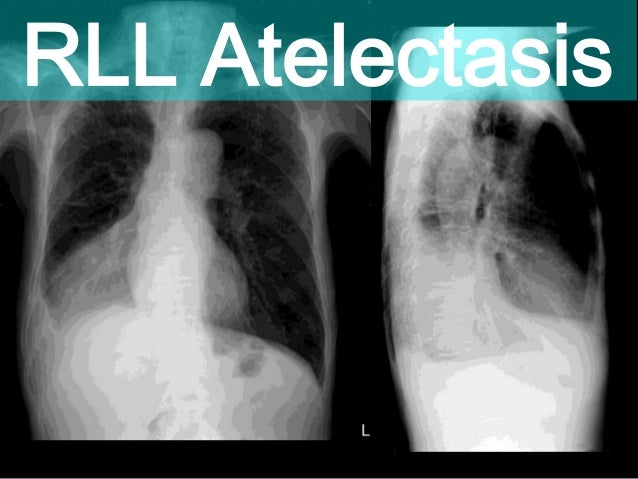 Atelectasis and collapse in CXR