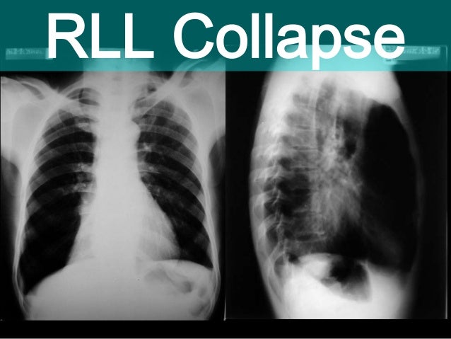 Atelectasis and collapse in CXR