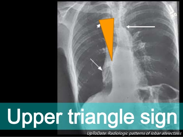 Atelectasis and collapse in CXR