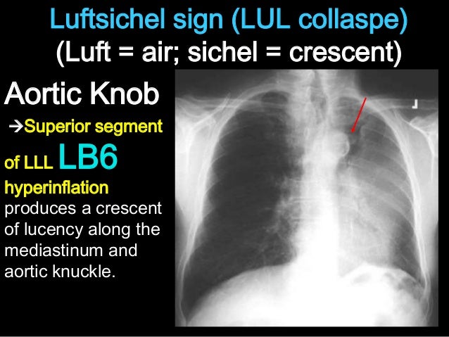 Atelectasis and collapse in CXR