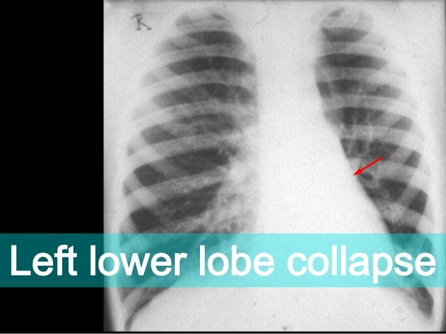 Atelectasis and collapse in CXR