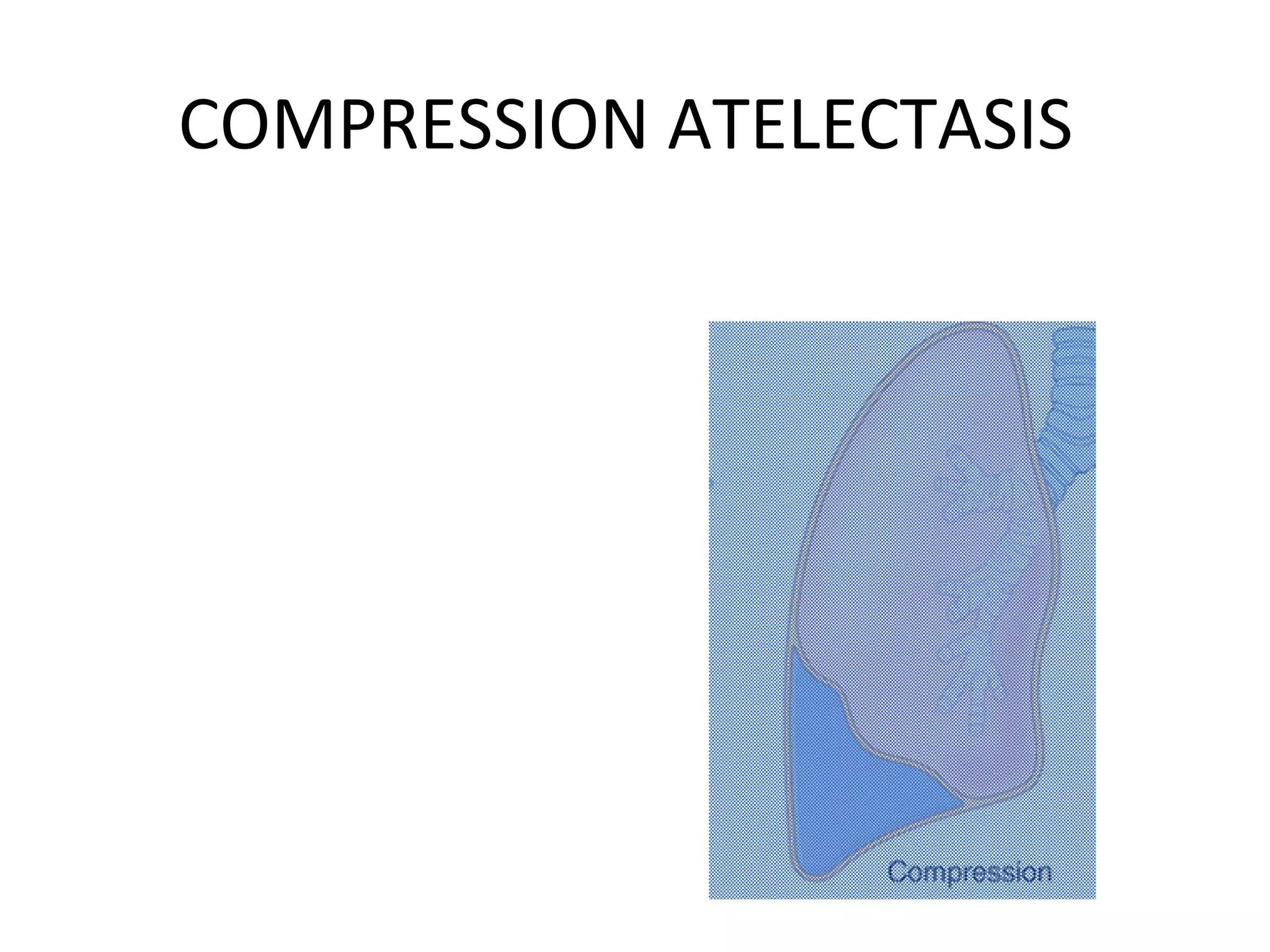 Atelectasis (collapse) | PPT