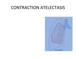 Atelectasis (collapse) | PPT