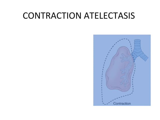 Atelectasis (collapse) | PPT