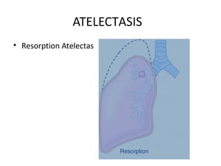 Atelectasis (collapse) | PPT