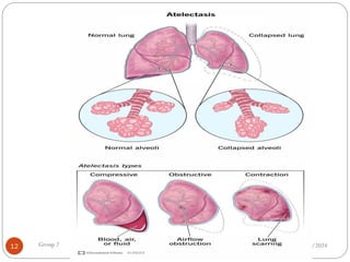 Lower respiratory tract disorder ATELECTASIS | PPTX