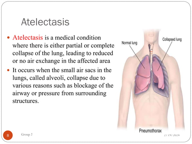 Lower respiratory tract disorder ATELECTASIS | PPT